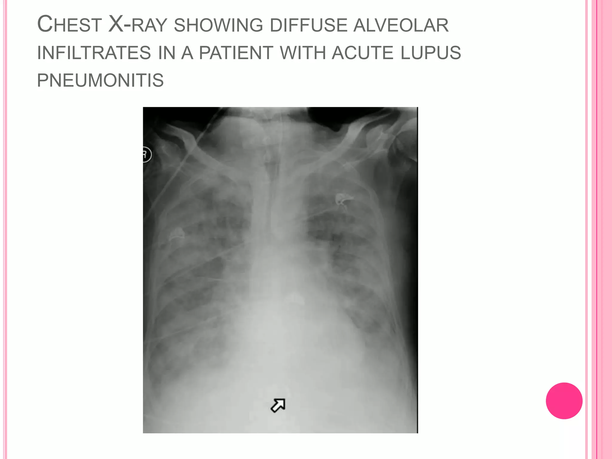 Pulmonary manifestations of systemic lupus erythematosis | PPTX