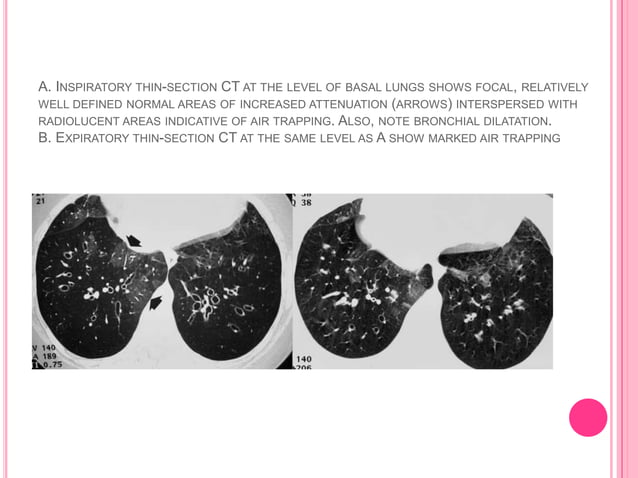 Pulmonary manifestations of systemic lupus erythematosis | PPTX