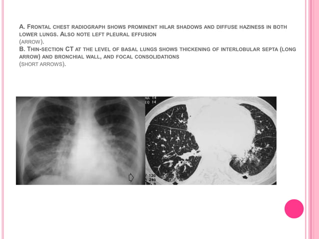 Pulmonary manifestations of systemic lupus erythematosis | PPTX