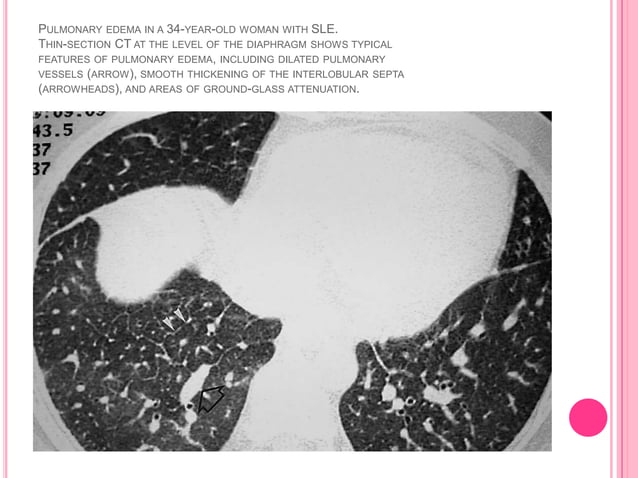 Pulmonary manifestations of systemic lupus erythematosis | PPTX