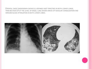 Pulmonary manifestations of systemic lupus erythematosis | PPTX
