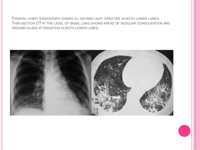 Pulmonary manifestations of systemic lupus erythematosis