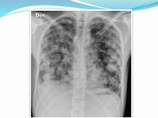 Pulmonary metastases | PPTX