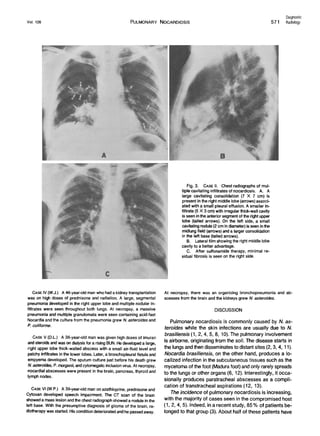 Pulmonary nocardiosis | PDF