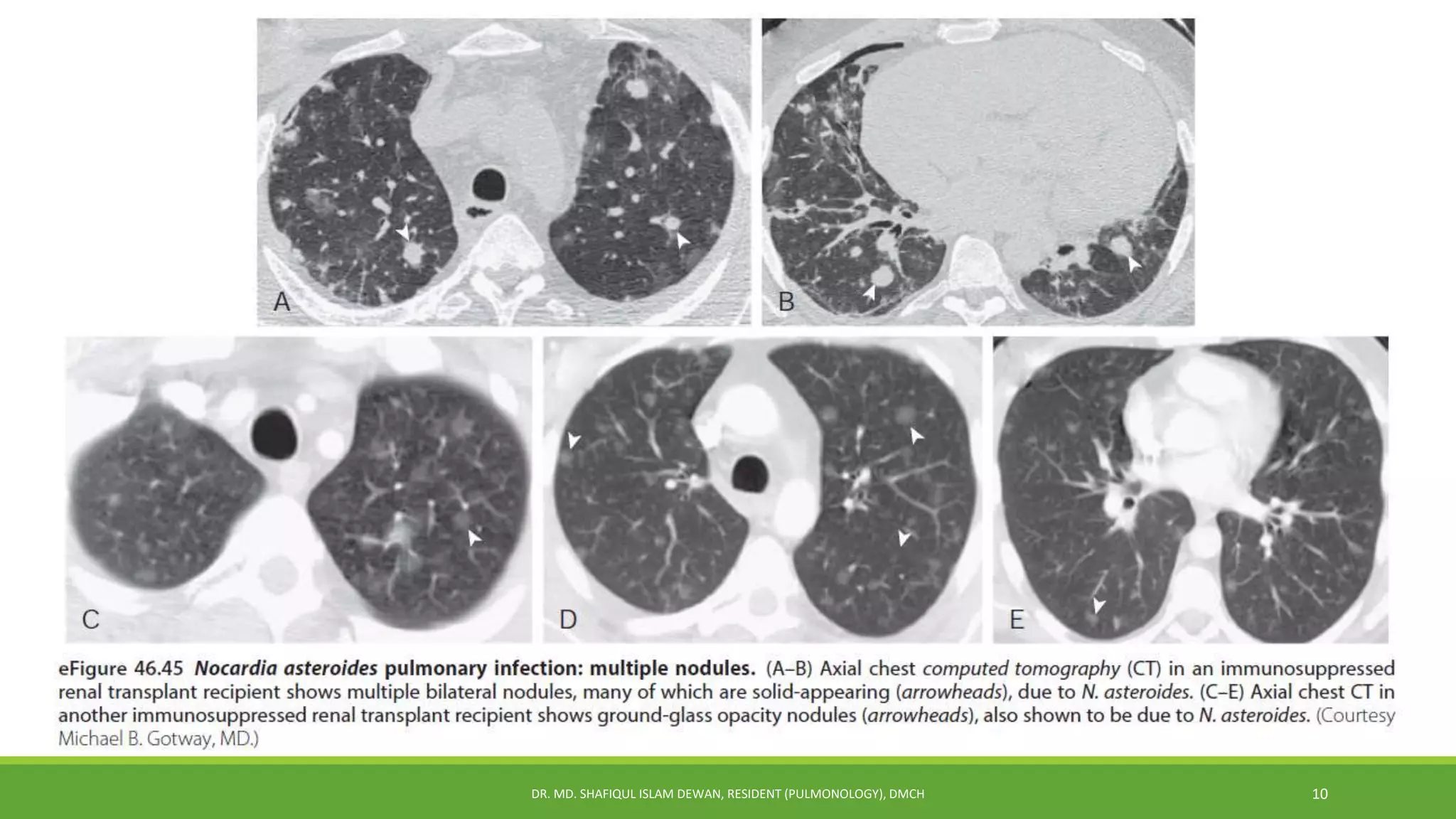 Pulmonary Nocardiosis.pptx