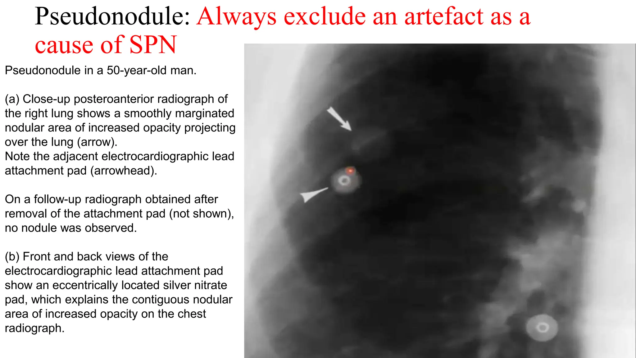 Approach to imaging of Solitary pulmonary nodule .pptx