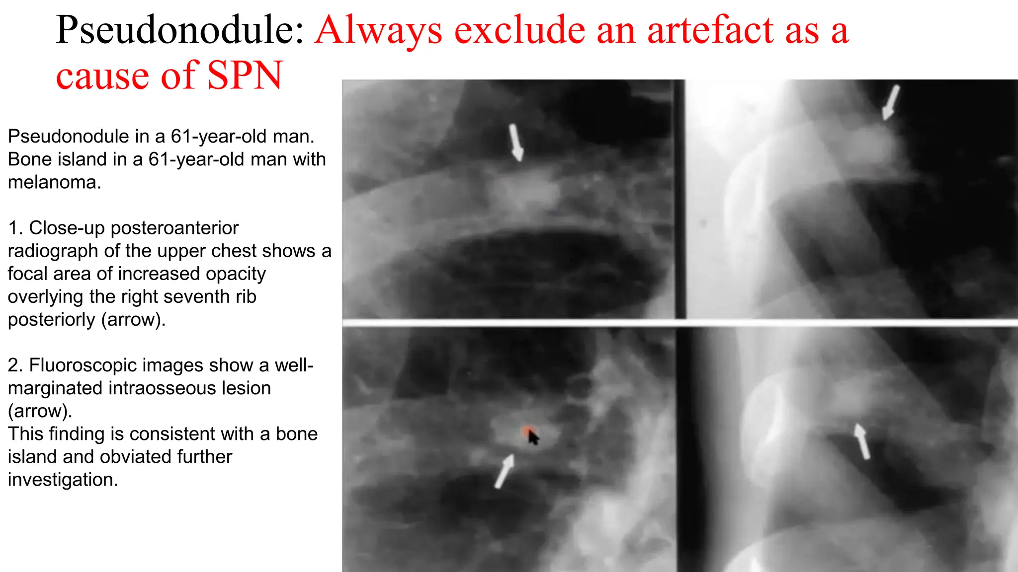 Approach to imaging of Solitary pulmonary nodule .pptx