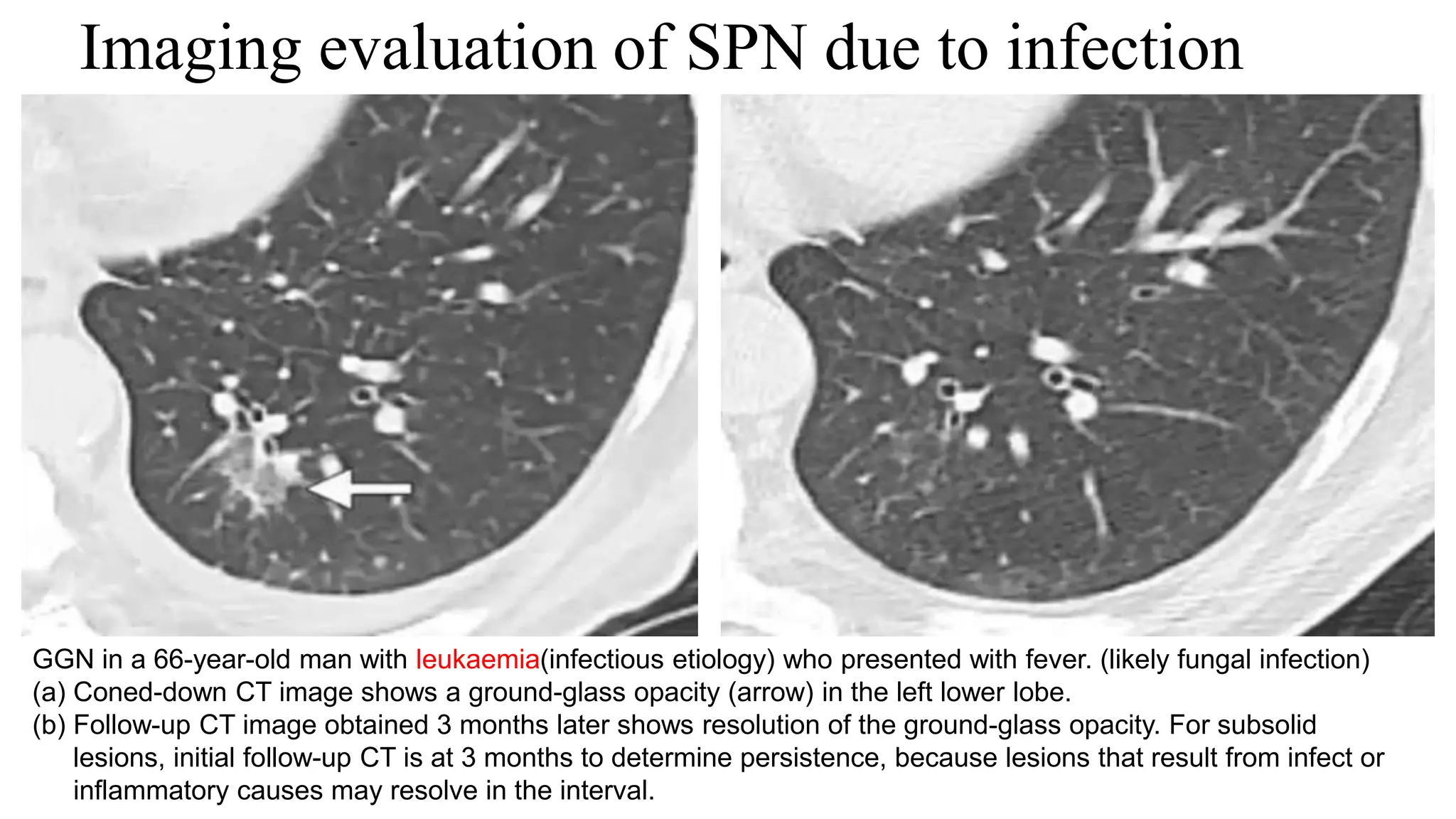 Approach to imaging of Solitary pulmonary nodule .pptx