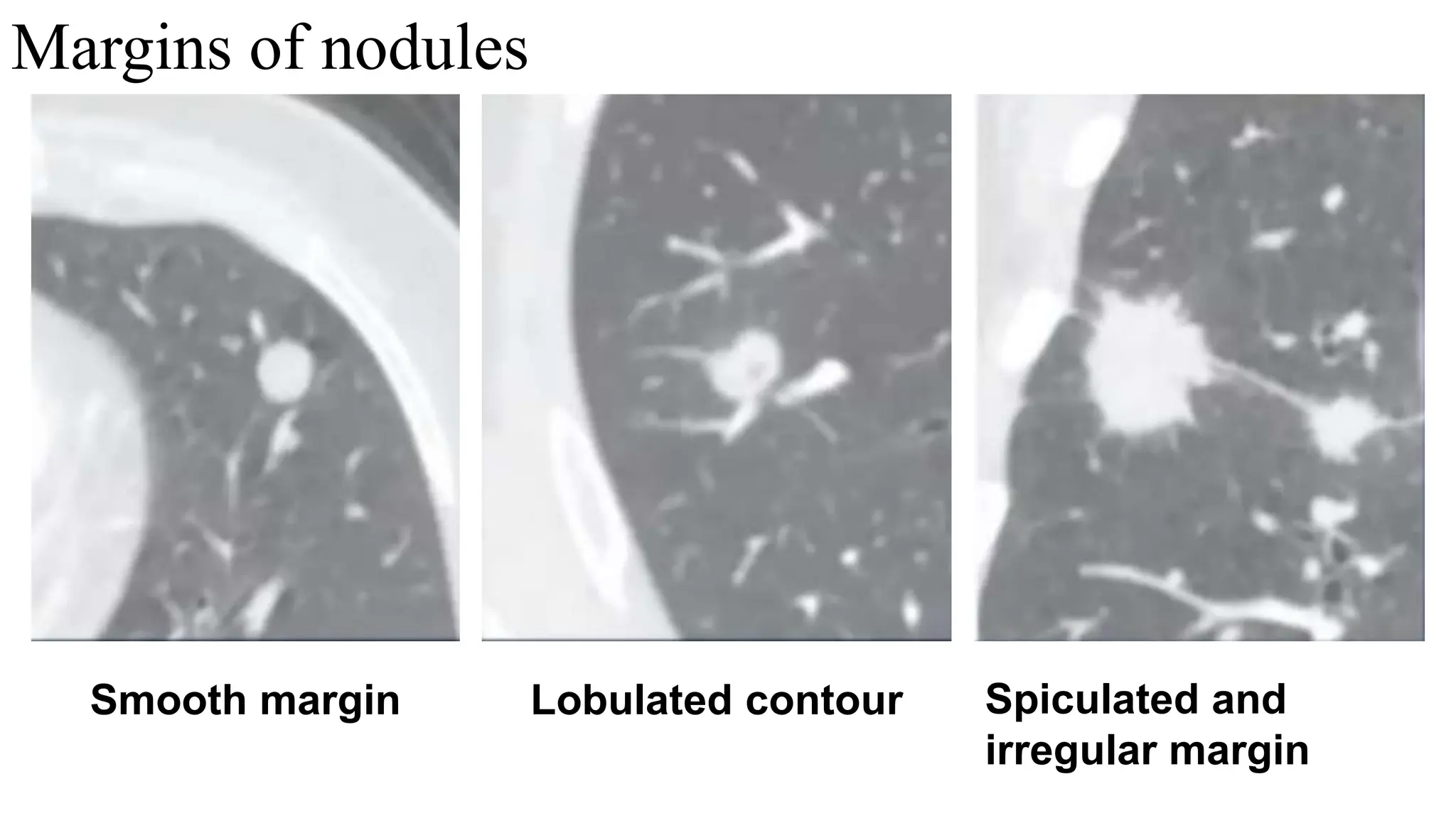 Approach to imaging of Solitary pulmonary nodule .pptx
