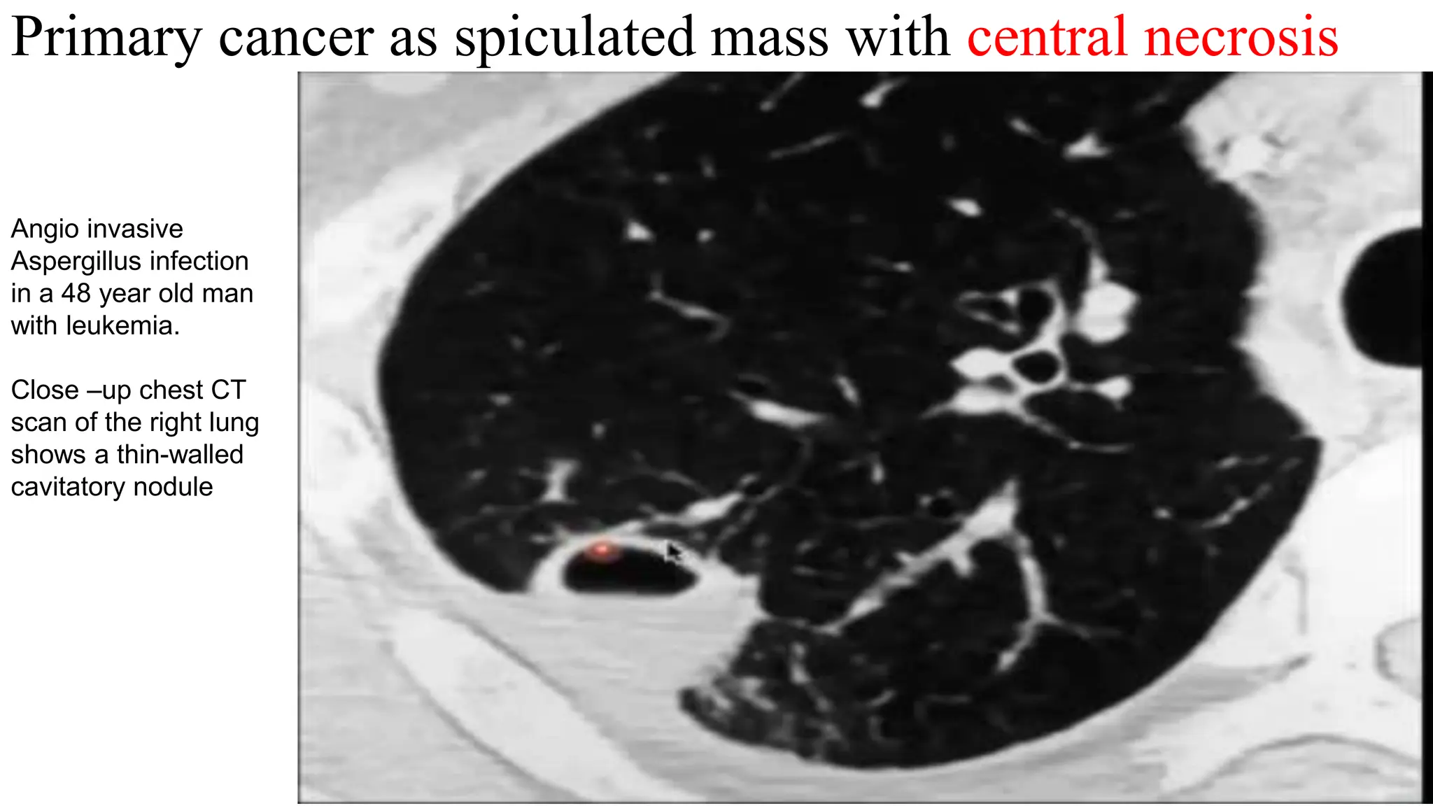 Approach to imaging of Solitary pulmonary nodule .pptx
