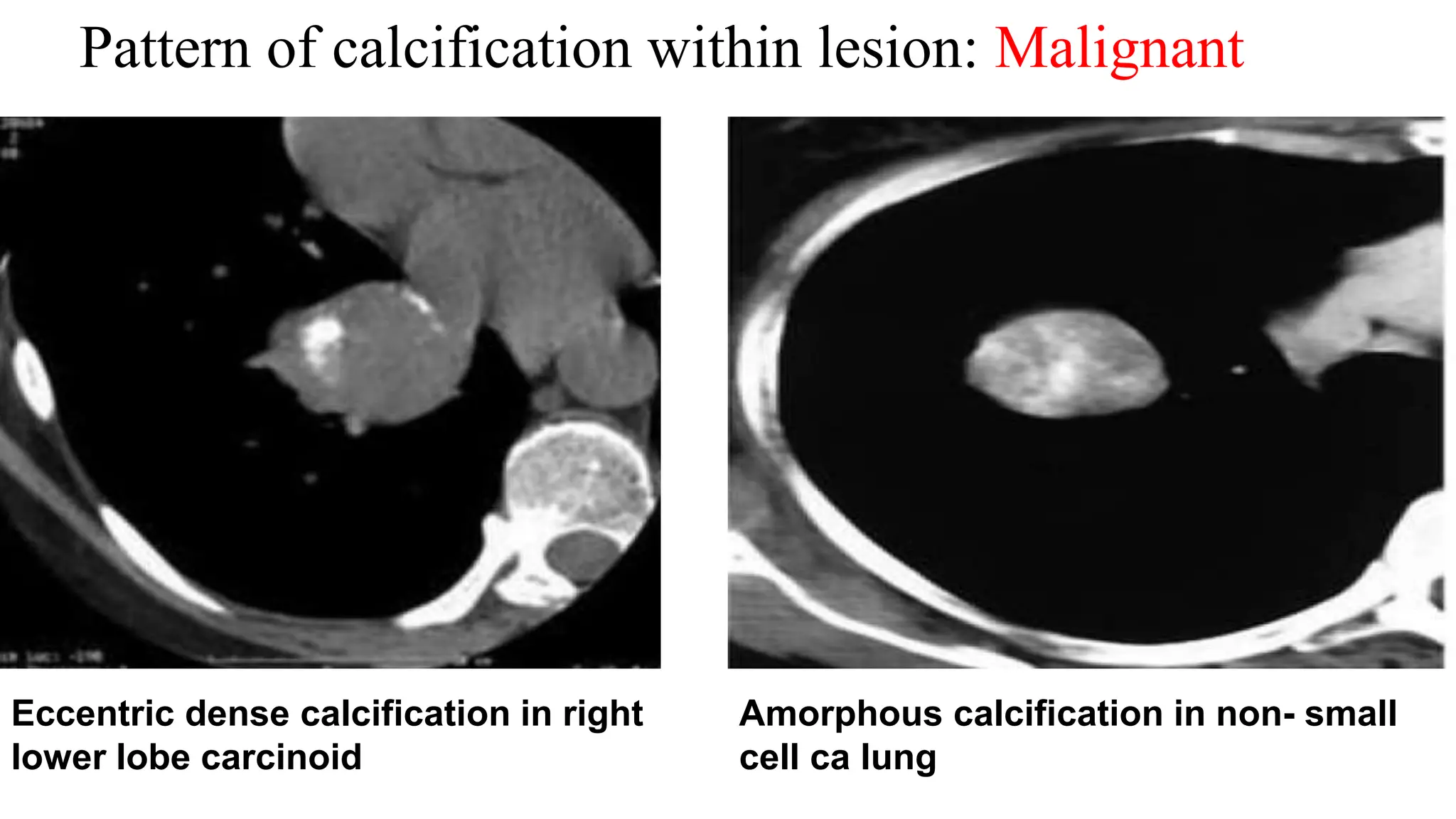 Approach To Imaging Of Solitary Pulmonary Nodule Pptx