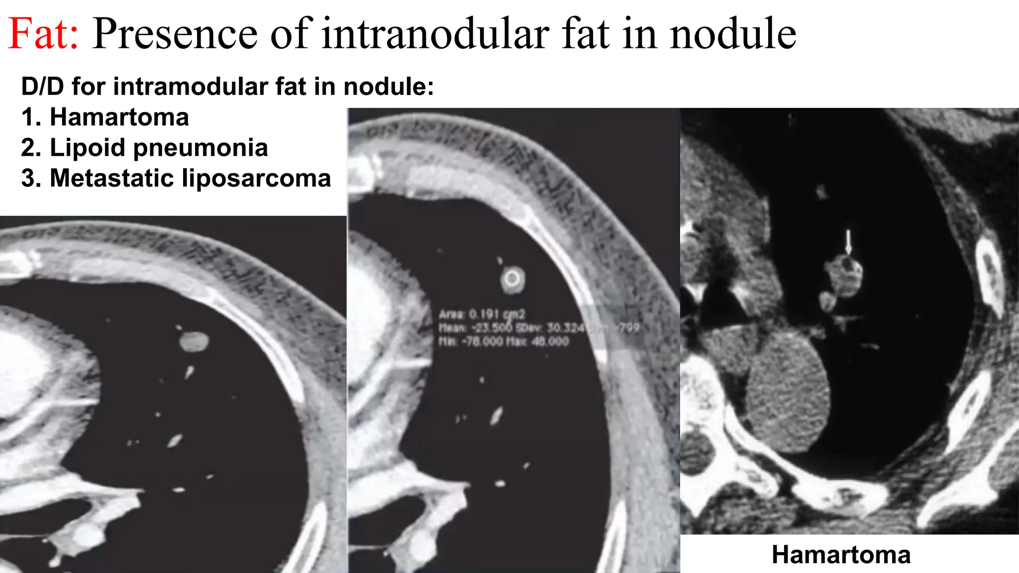 Approach To Imaging Of Solitary Pulmonary Nodule Pptx