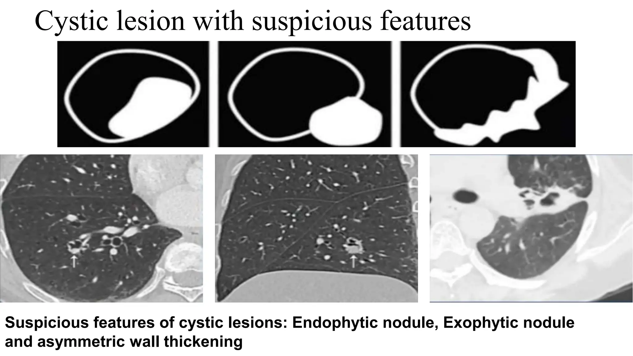 Approach to imaging of Solitary pulmonary nodule .pptx