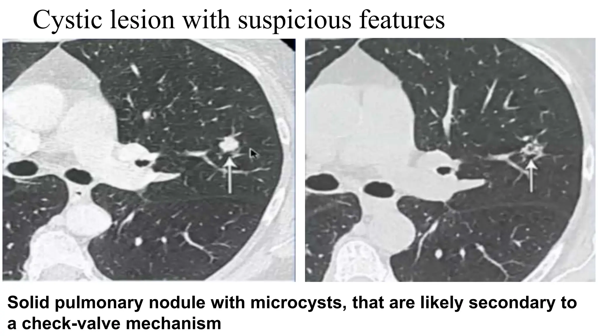 Approach to imaging of Solitary pulmonary nodule .pptx