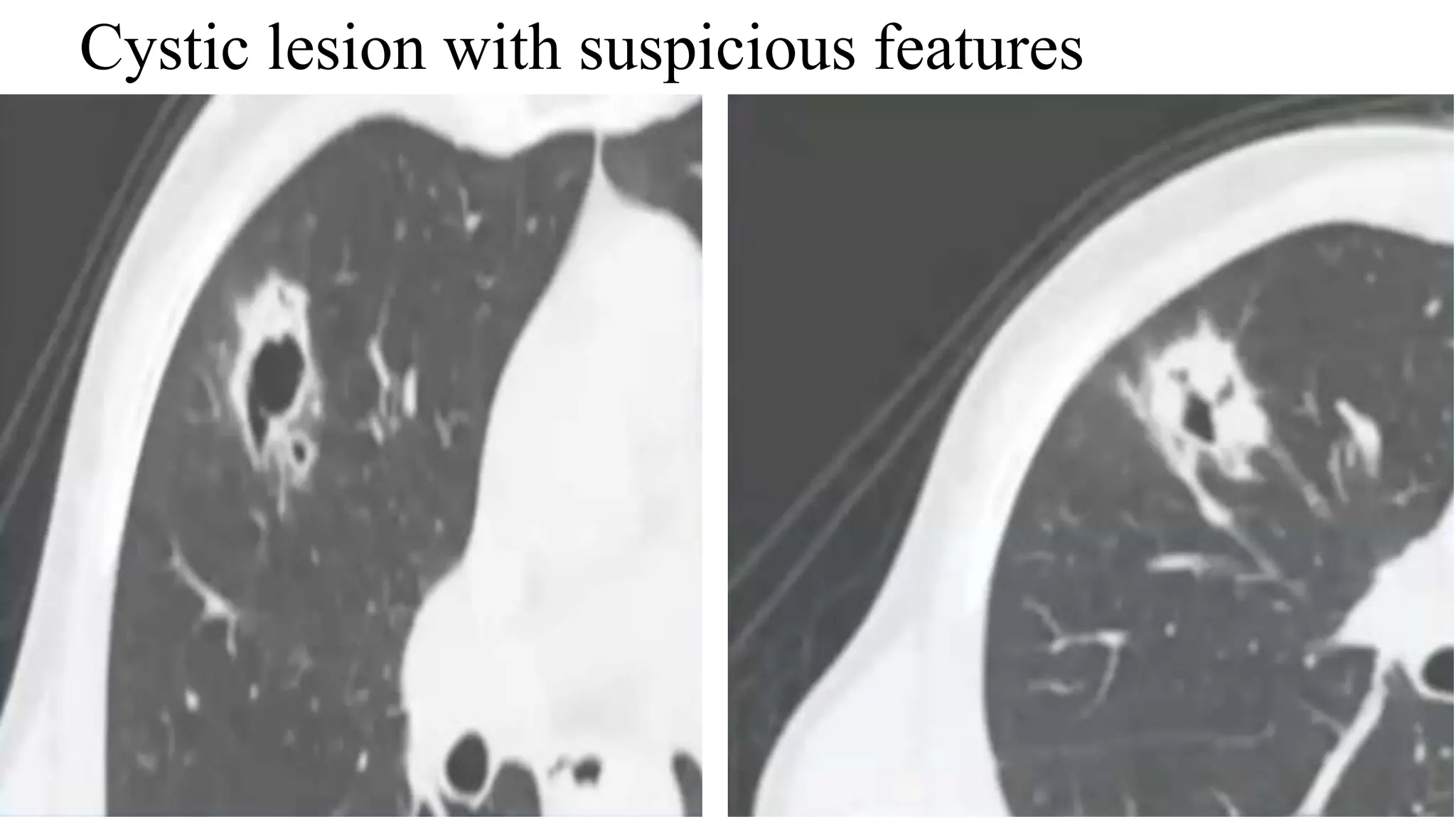 Approach To Imaging Of Solitary Pulmonary Nodule Pptx