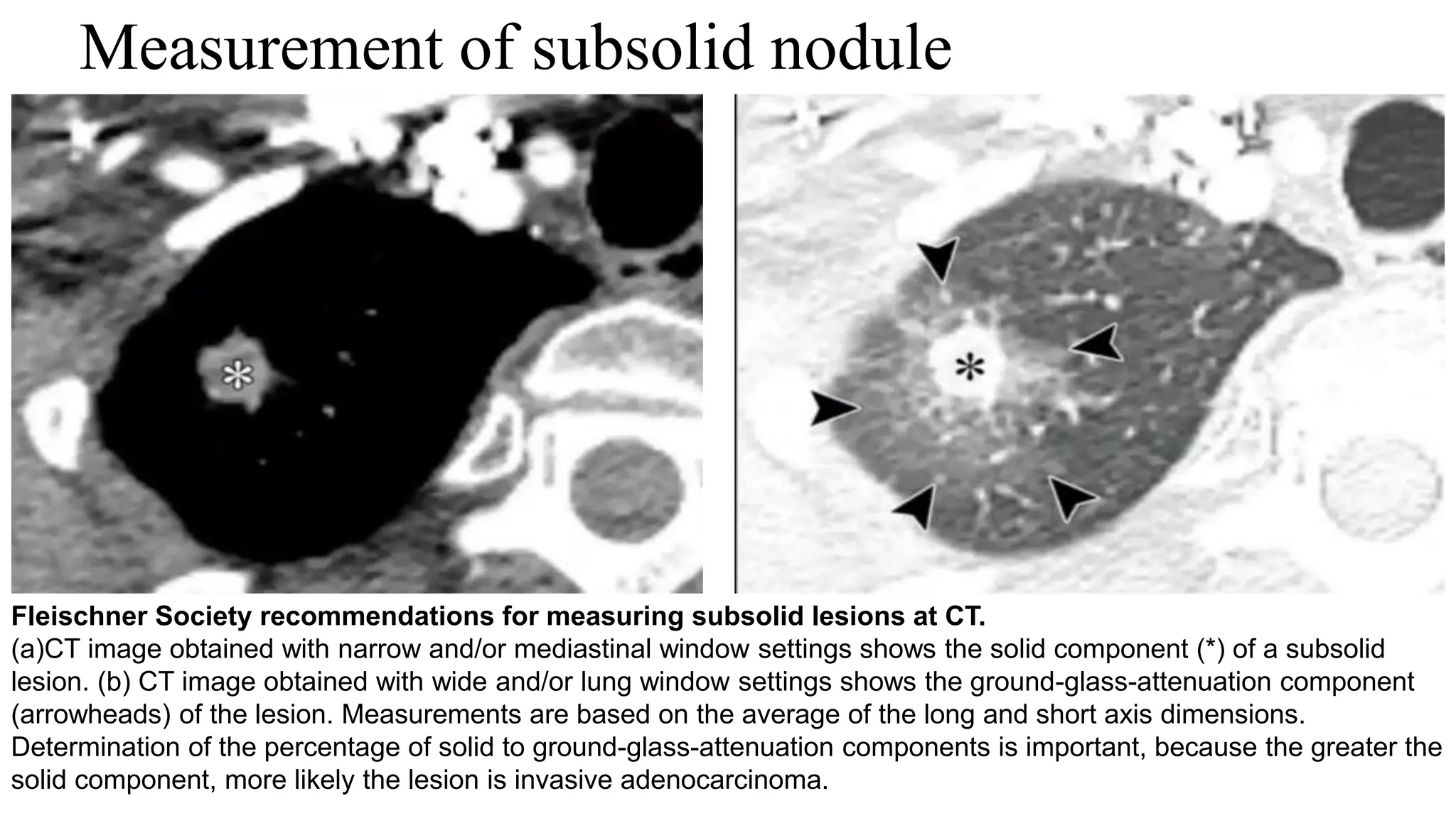 Approach to imaging of Solitary pulmonary nodule .pptx
