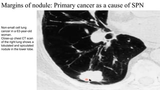 Approach to imaging of Solitary pulmonary nodule .pptx