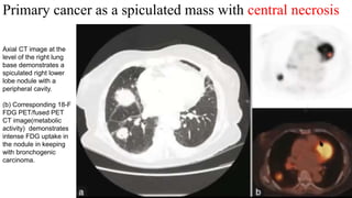 Approach to imaging of Solitary pulmonary nodule .pptx