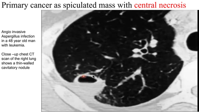 Approach To Imaging Of Solitary Pulmonary Nodule Pptx