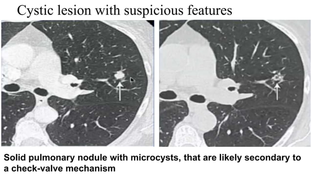 Approach to imaging of Solitary pulmonary nodule .pptx