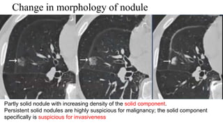 Approach to imaging of Solitary pulmonary nodule .pptx