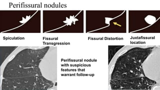 Approach to imaging of Solitary pulmonary nodule .pptx