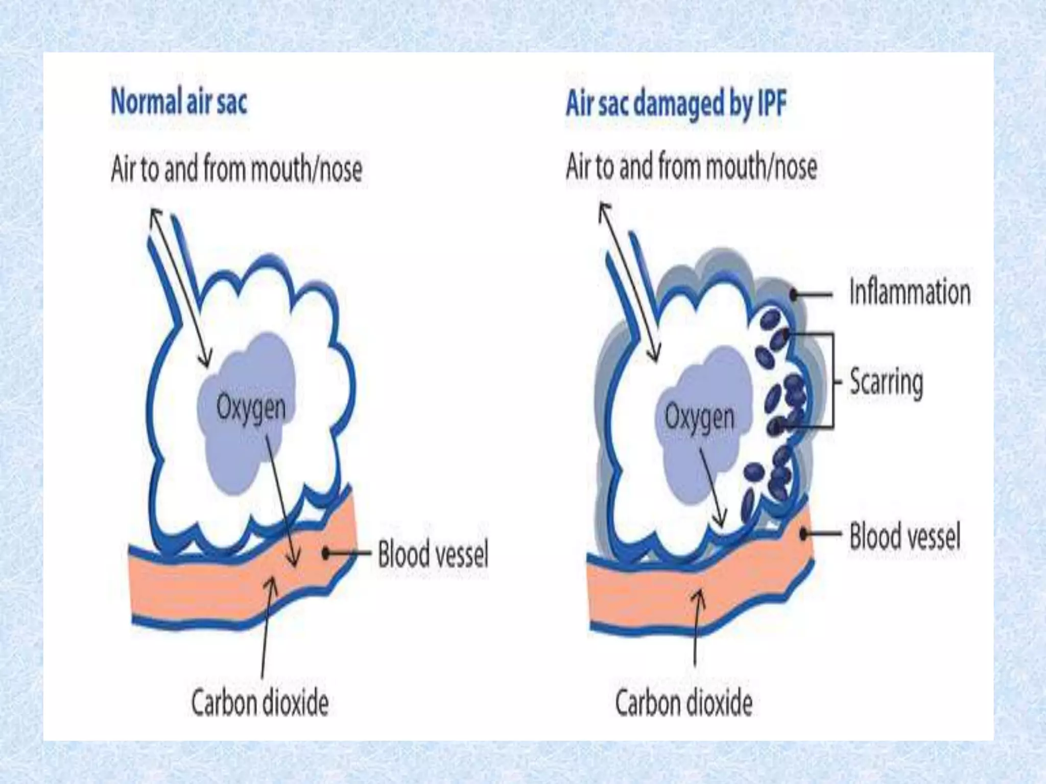 Pulmonary rehabilitation in interstitial lung disease | PPTX