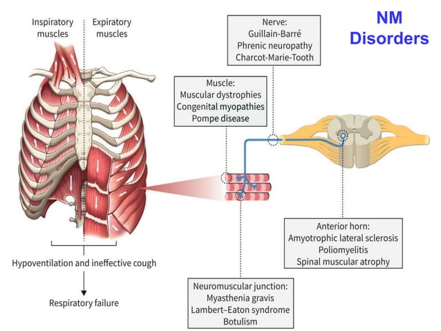 Pulmonary Rehabilitation in NM Disorders.ppt