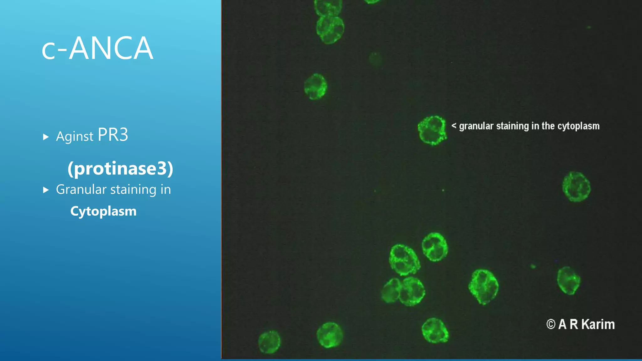 Pulmonary renal syndrome by Dr Bharat Rewaria | PPTX