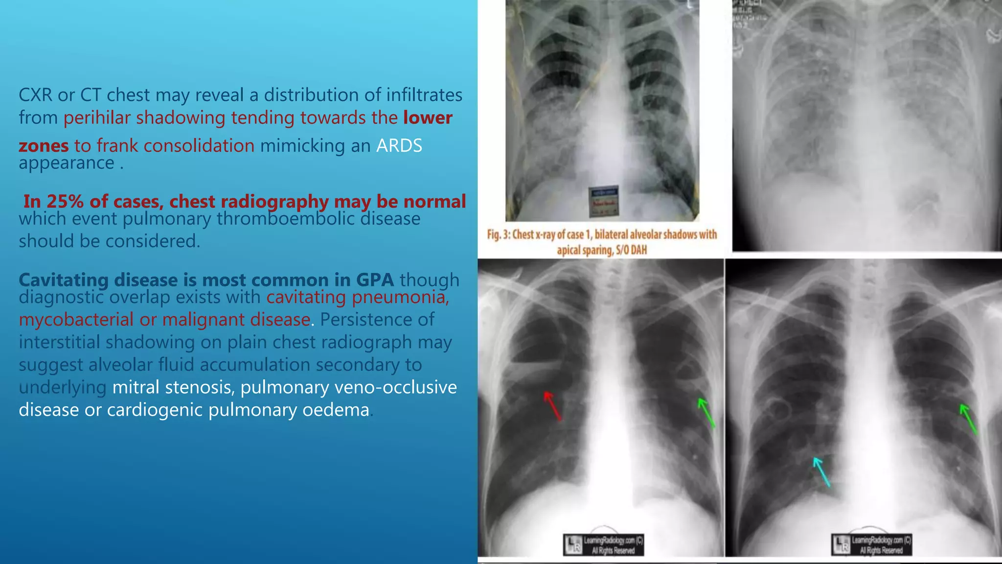 Pulmonary renal syndrome by Dr Bharat Rewaria | PPTX