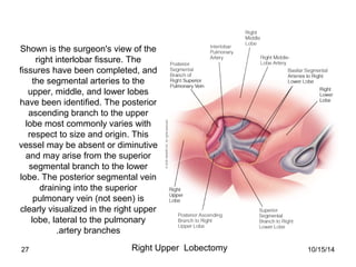 Right Upper Lobectomy Technique