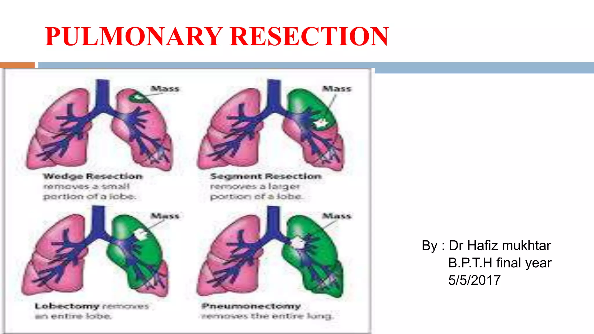Pulmonary Resection By Dr Hafeez Mukhtar Pptx
