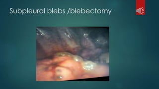 Pulmonary resection | PPTX