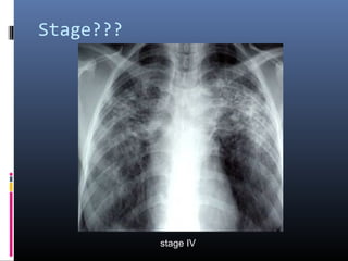 Sarcoidosis Lung Stages