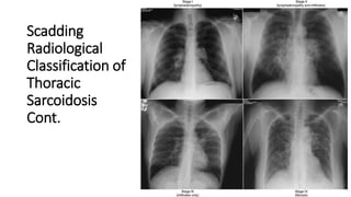 Pulmonary Sarcoidosis.pptx