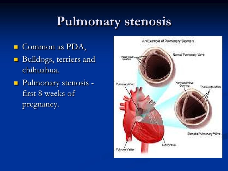 Pulmonary stenosis