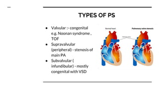 Pulmonary stenosis | PPTX