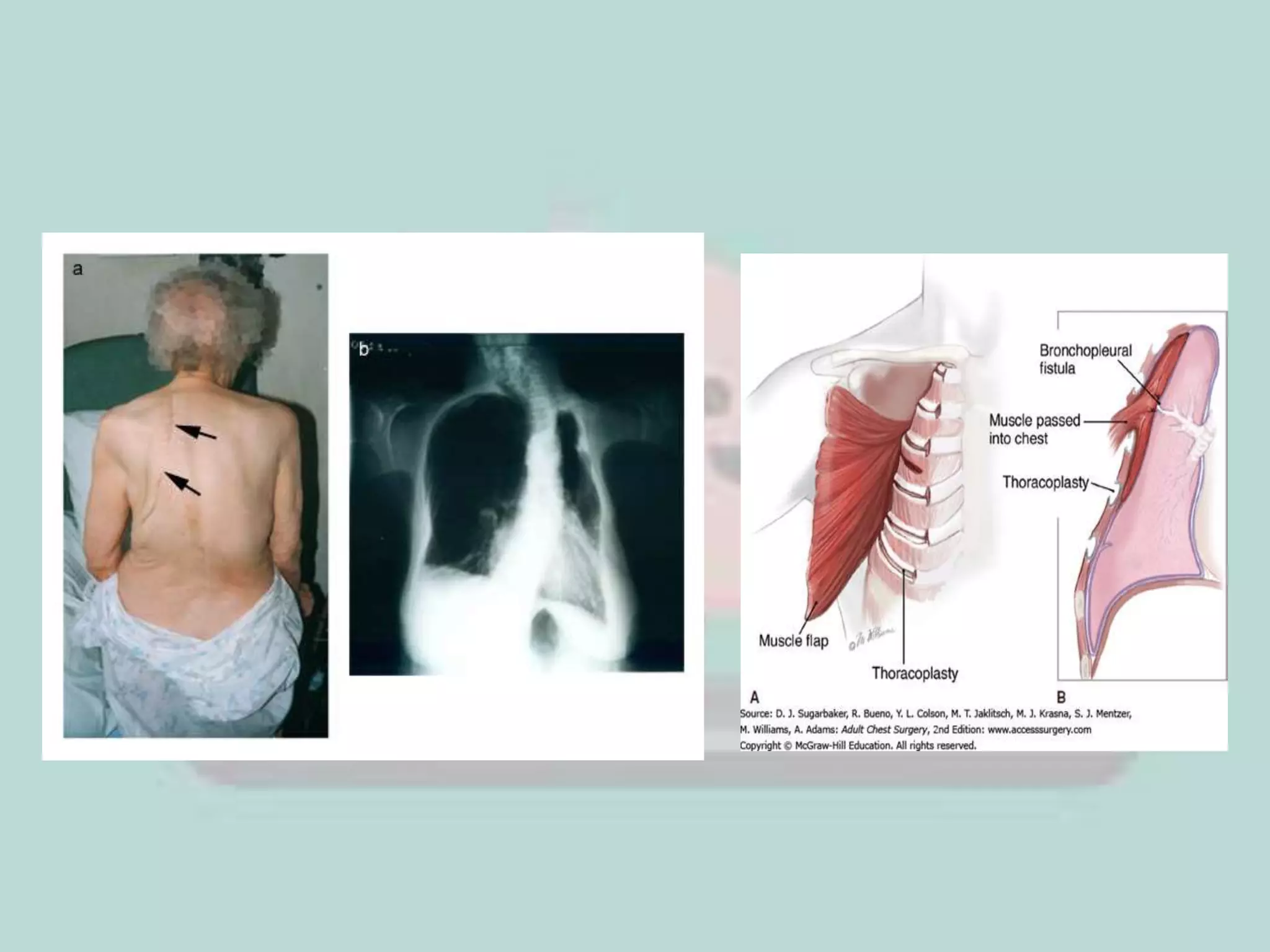 Pulmonary surgeries | PPTX