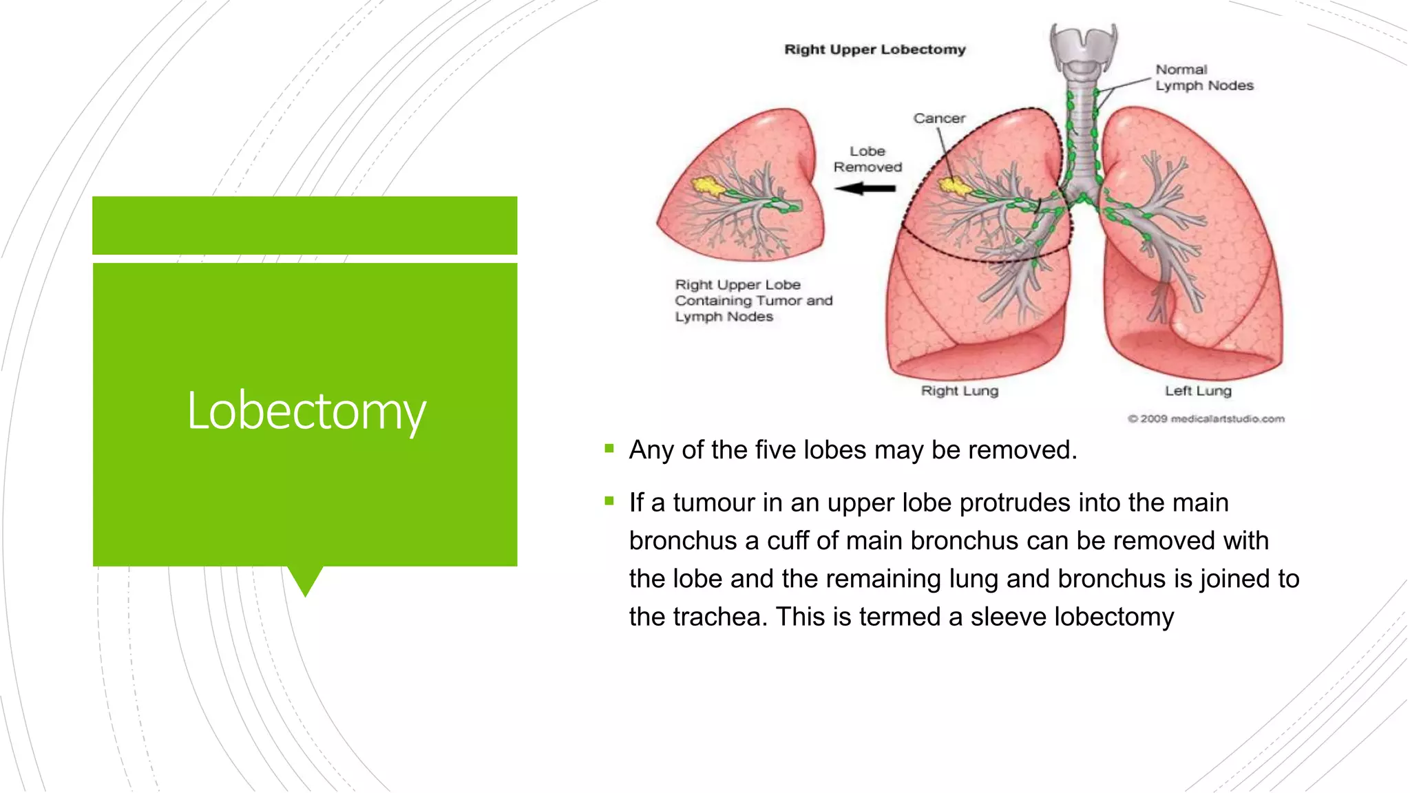 Physiotherapy in pulmonary_surgery[1].pptx