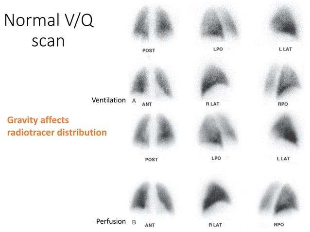 V/Q scan | PPT