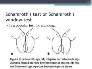 Pulmonary system (PS) examination | PPTX