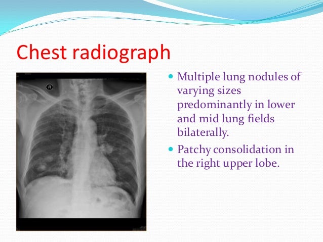 Pulmonary Tuberculosis - 1