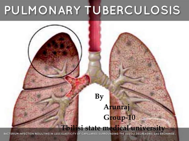 Pulmonary tuberculosis | PPT