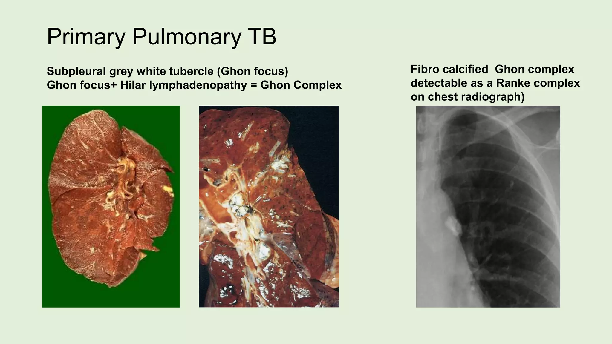 Pulmonary tb lec | PPTX
