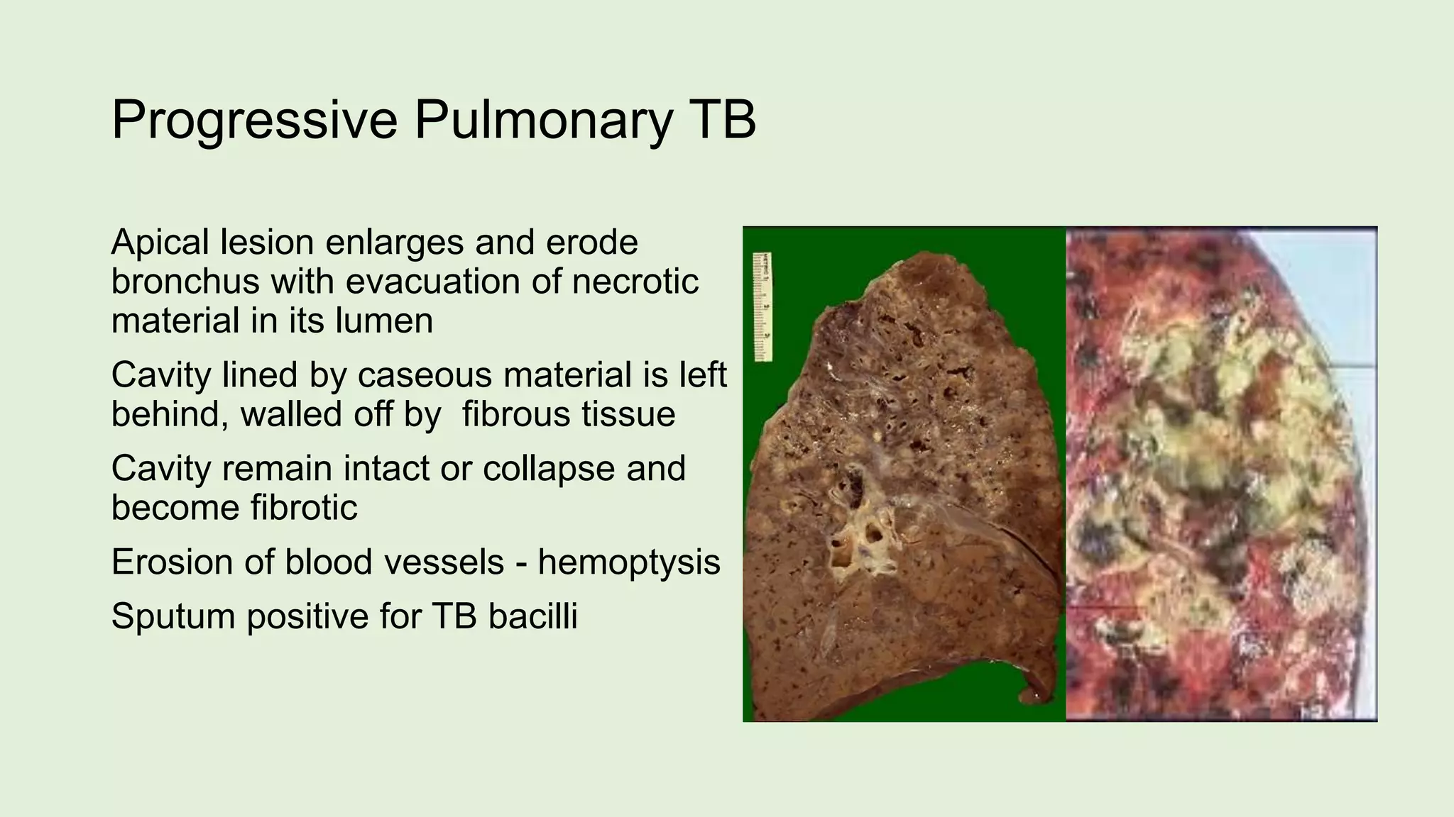 Pulmonary tb lec & practical | PPTX