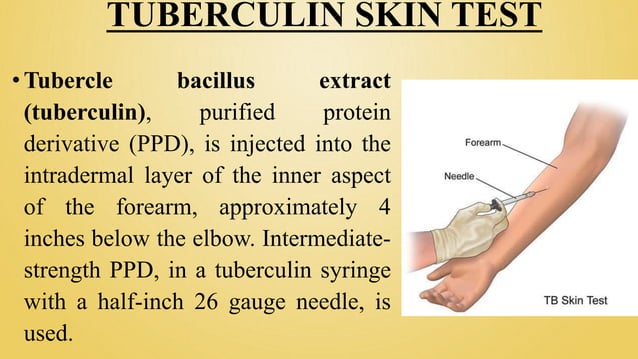 Pulmonary TB (Tuberculosis) PPT SlideShare | PPTX