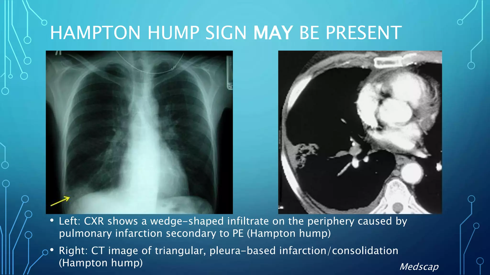 Pulmonary thromboembolism | PPTX