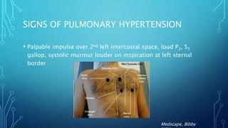 Pulmonary thromboembolism | PPTX