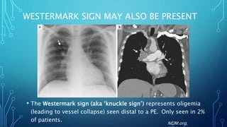 Pulmonary thromboembolism | PPTX