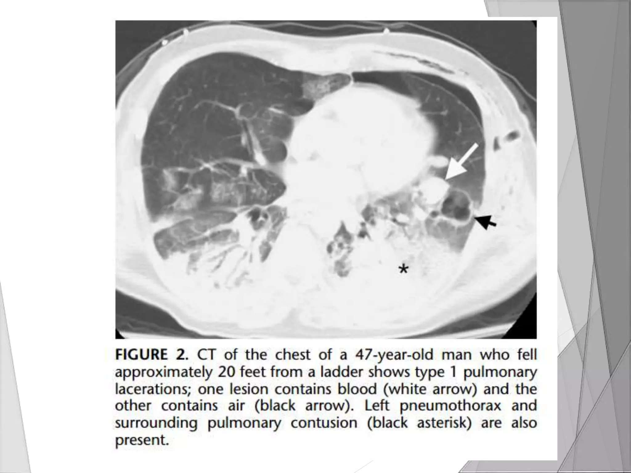 Pulmonary trauma | PPT